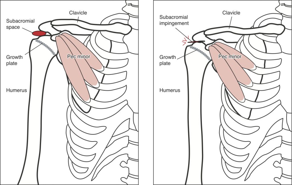 Kids Shoulder Pain: 3 Ways to Fix - Orange County Pediatric and Sports ...